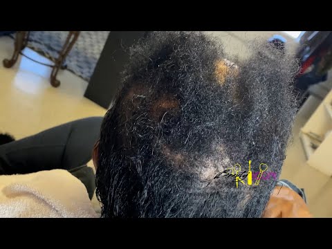 Don’t be worried about alopecia, just embrace it. We Got Options!!!
