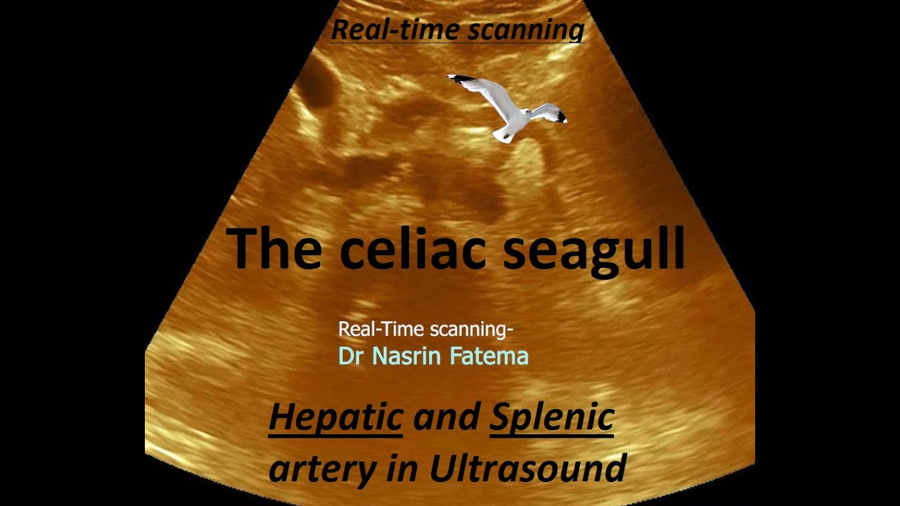 The celiac seagull in ultrasound II Seagull sign ultrasound II celiac ...