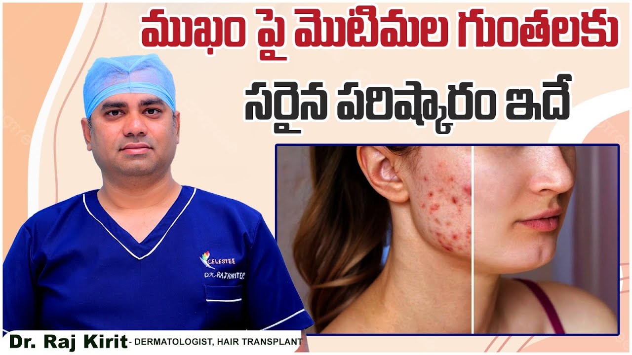 How To Treat Acne Scars On Face Motimala how-to-treat-acne-scars-on-face-motimala
