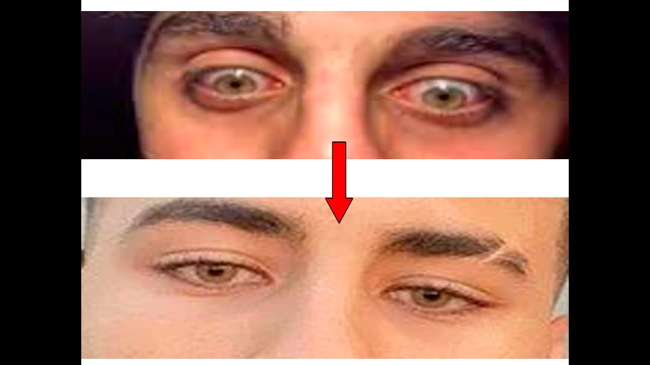 🔥 How To Become a Mogger - Best Eye Area Looksmaxxing Tips - YouTube