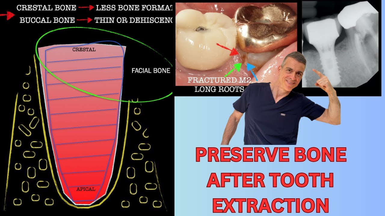 Best way to do a broken tooth extraction - YouTube