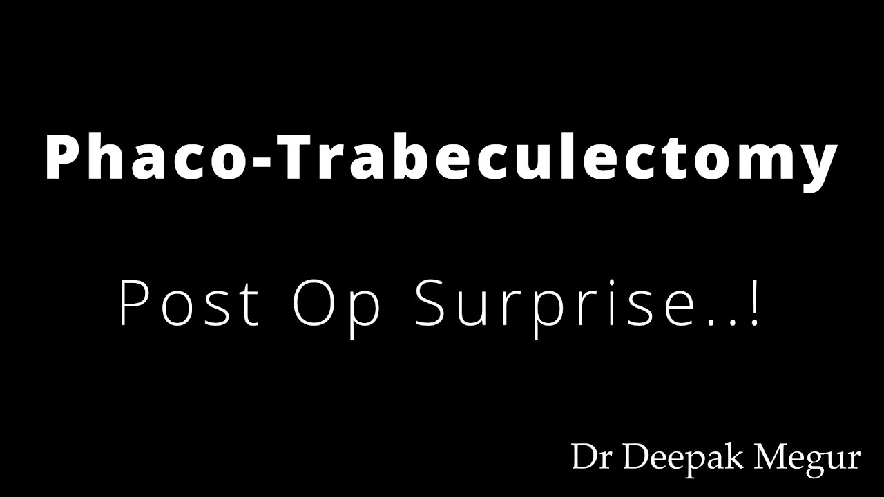 Phaco-Trabeculectomy - Managing Post Op Events. Laser Sutorolysis ...