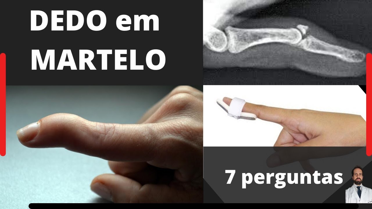 Dedo Do Pe Em Martelo Antes E Depois O Que é Dedo Em Martelo: O Que
