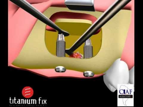 Enxerto - Levantamento de Seio da Face com implantes imediatos - YouTube