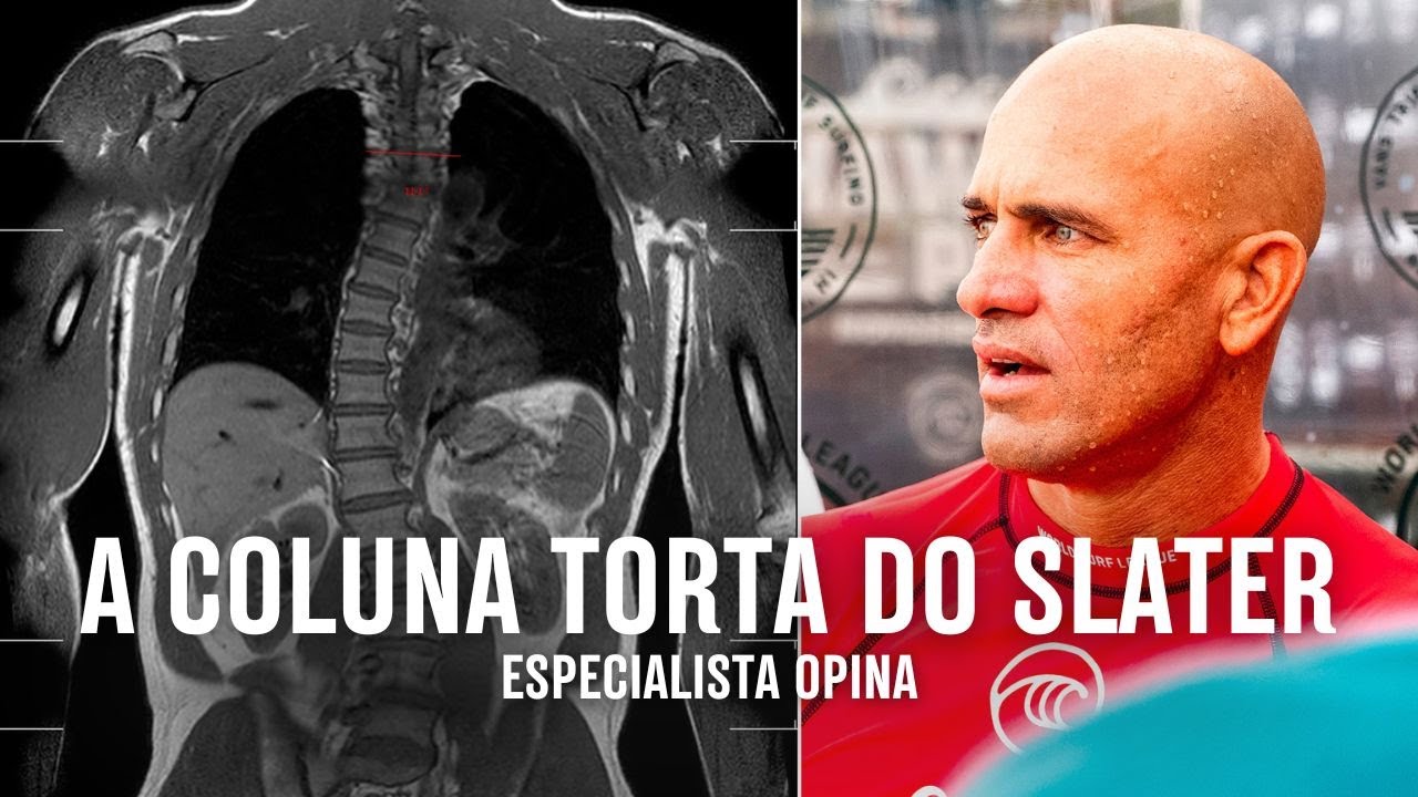 A coluna torta do Kelly Slater - especialista opina na TV Waves - YouTube