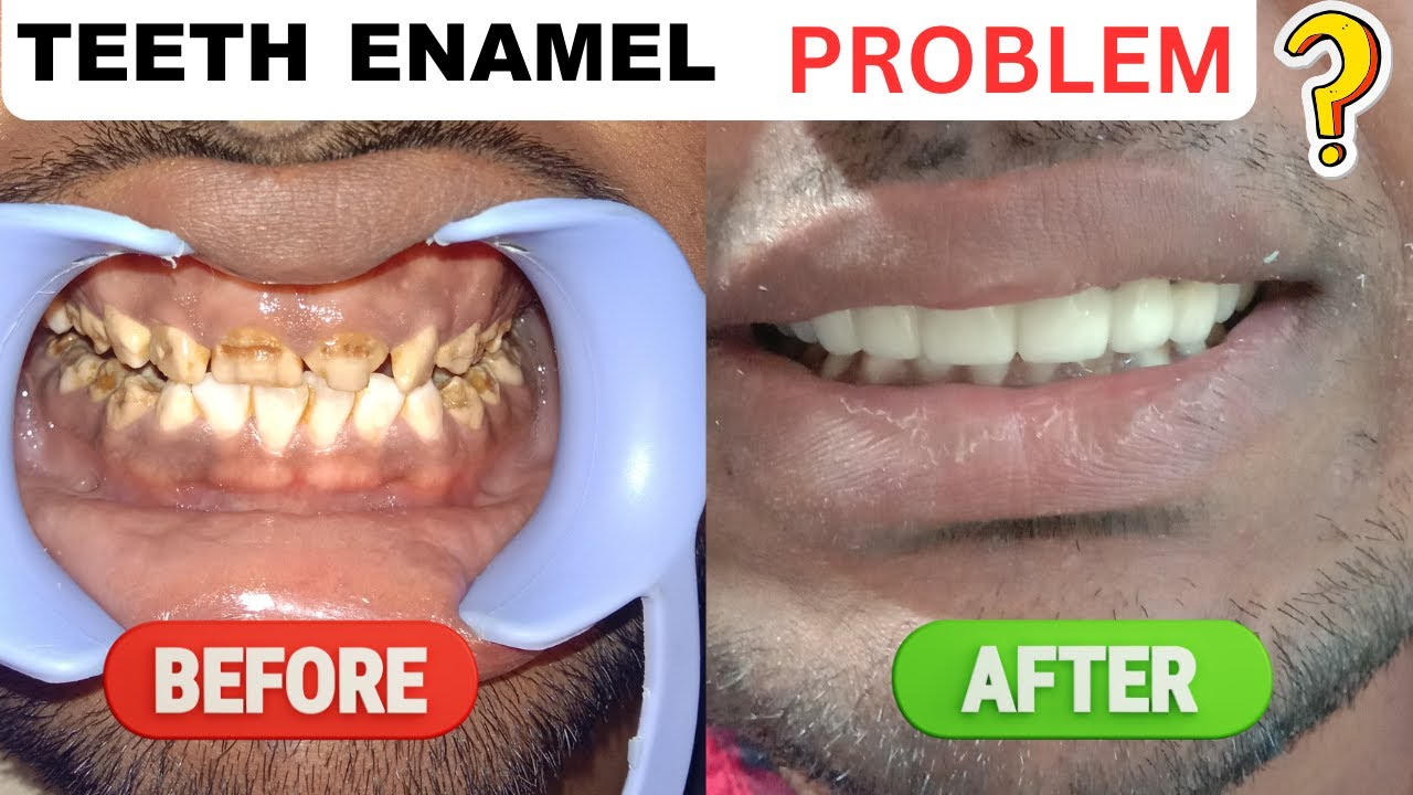 Teeth Enamel Problem | Some Ways To Ruin Enamel Problem In 4 Minutes ...