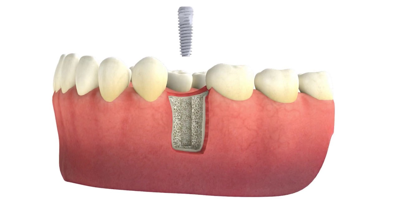 TRIANGULAR IMPLANT | Alpha Dent Active Bio - YouTube