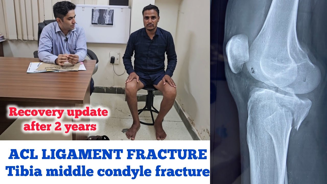 ACL ligament fracture and tibia middle condyle fracture Recovery update ...