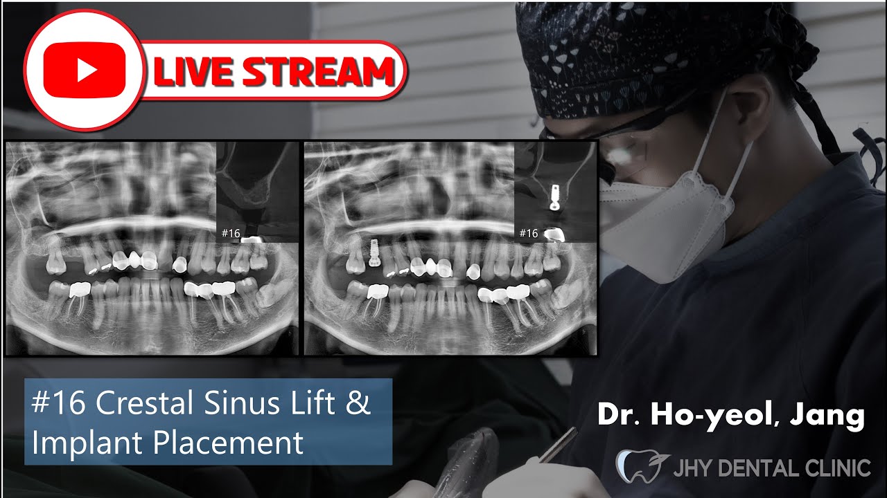 [Live Surgery] #16 implant placement with crestal sinus lift (Pop-up ...