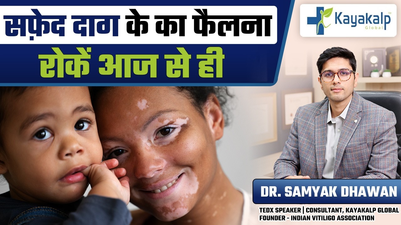 सफ़ेद दाग फैल रहा है? आज से रोकें ये 5 गलतियाँ | Stop Vitiligo ...