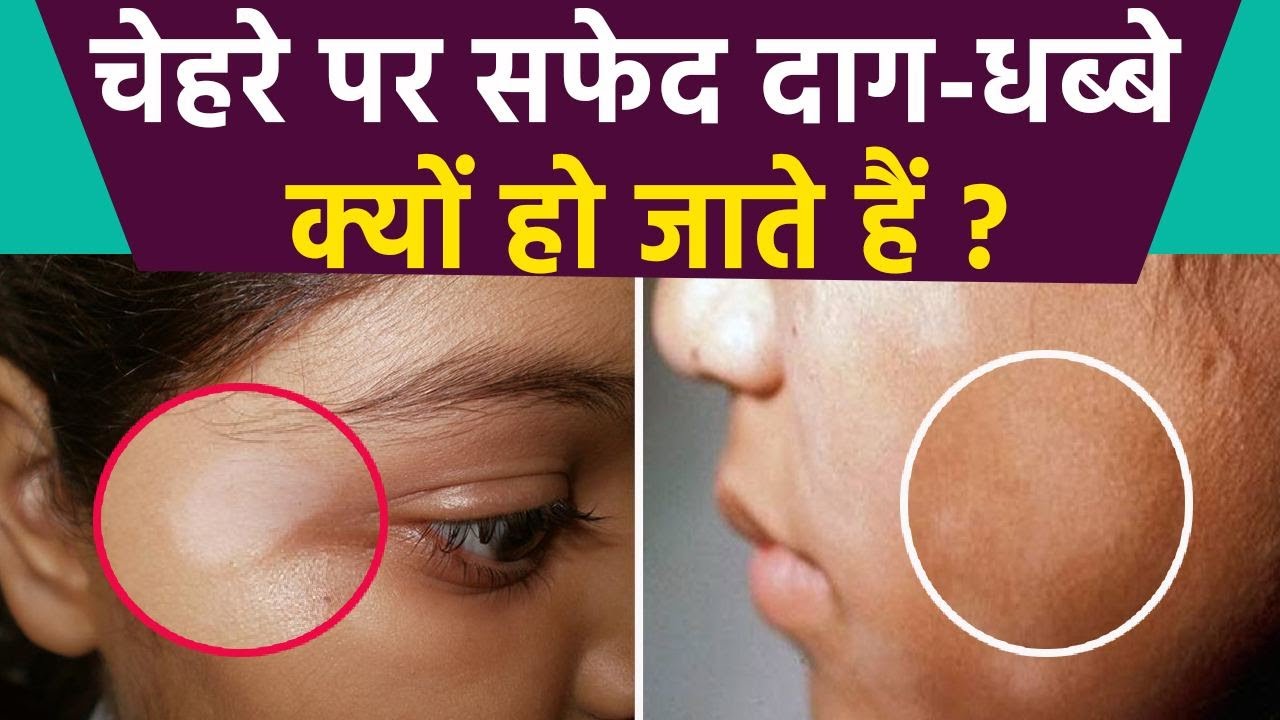 चेहरे पर सफेद दाग धब्बे होने का कारण | चेहरे पर सफेद दाग धब्बे क्यों हो ...
