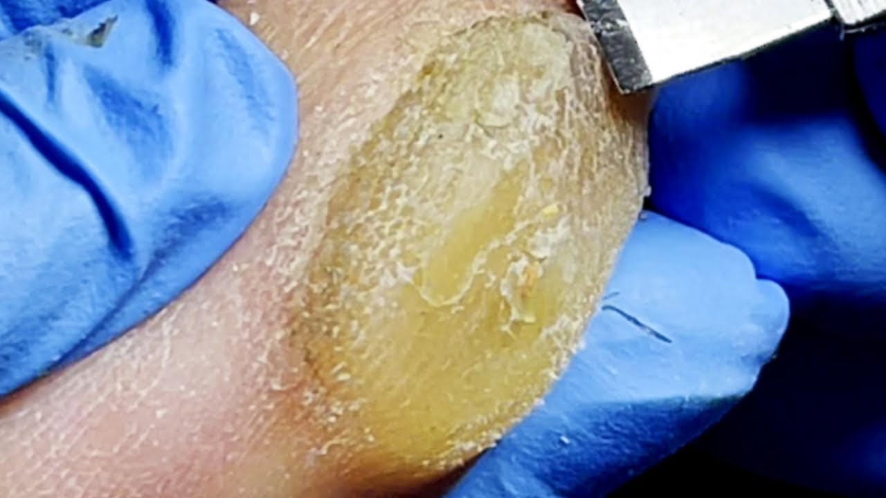 Cut off protruding toenails and remove calluses - YouTube