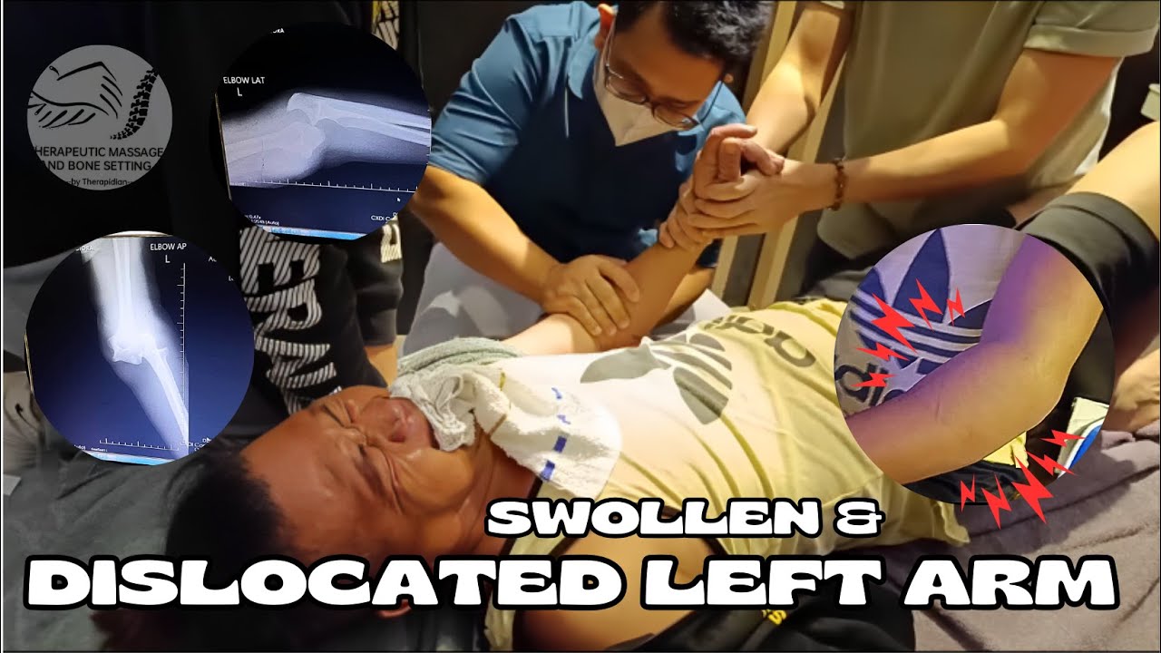 SWOLLEN DISLOCATED LEFT ARM ALIGNMENT - YouTube