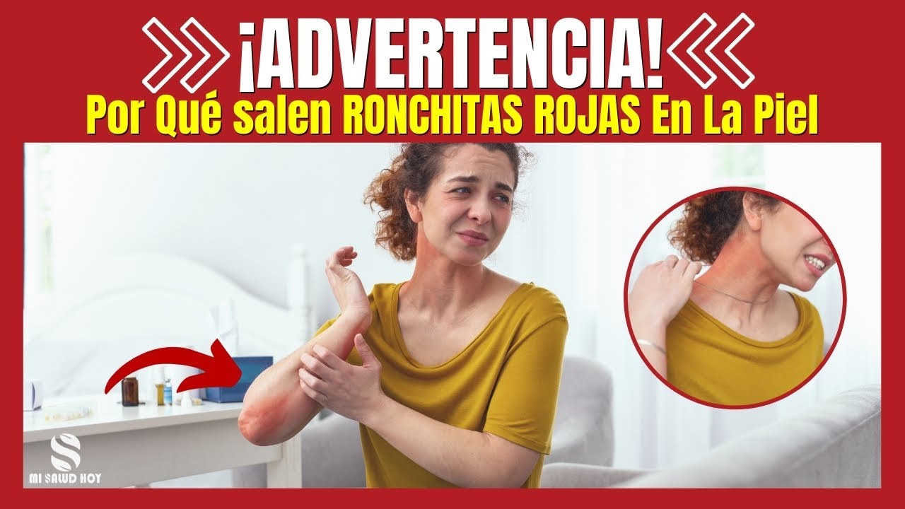 🤔 ¿Sabes Que Significan Las RONCHITAS ROJAS En La Piel? 🤔 - YouTube