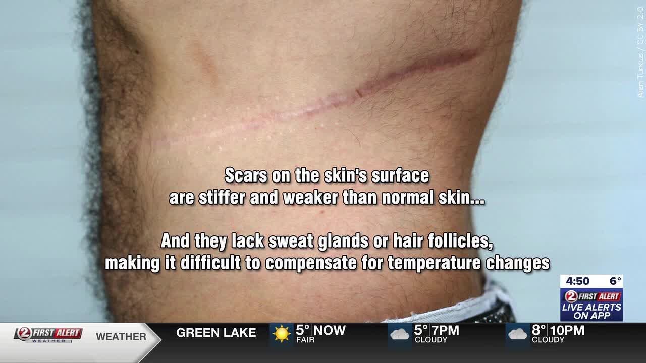 Scientists make new discoveries about scars - YouTube