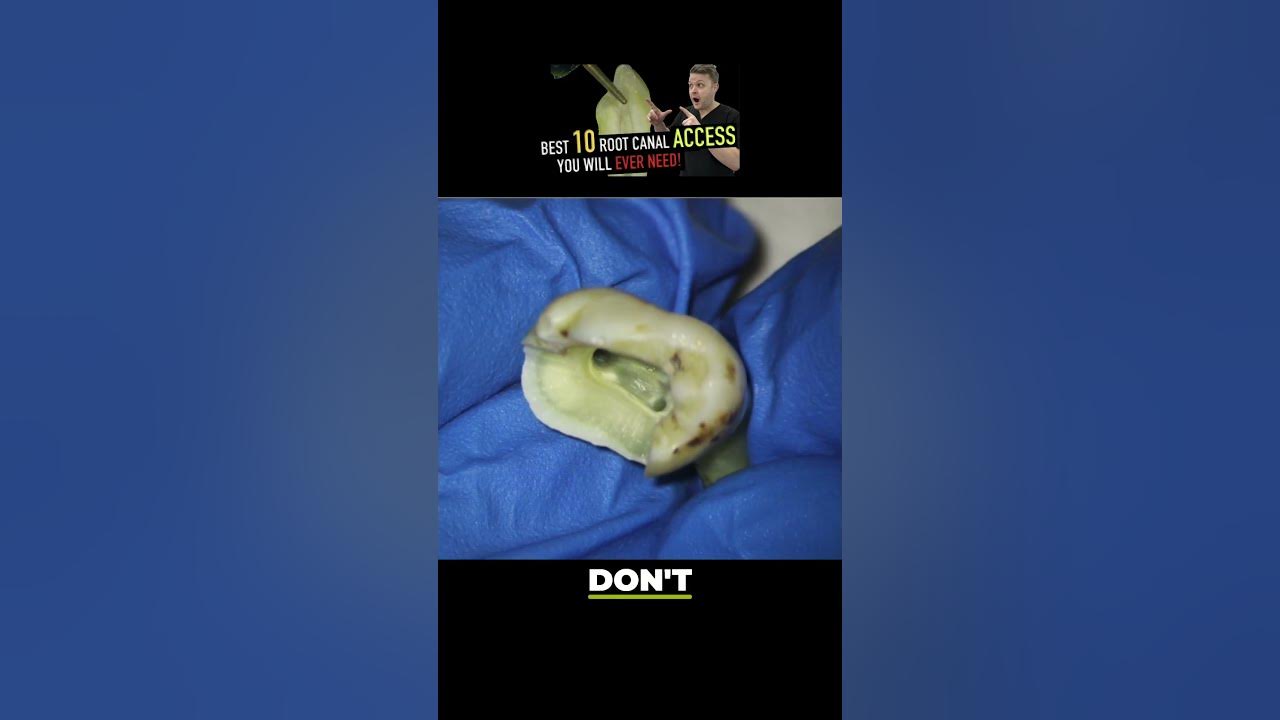 Mastering Root Canal Orifice Locations Key Techniques - YouTube