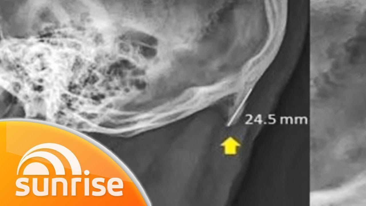 Phone use is causing a 'horn-like' bone growth in young people ...