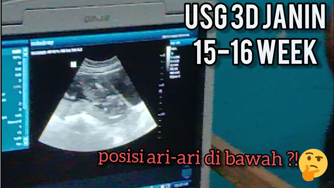 HASIL USG 3D USIA JANIN 15-16 MINGGU JANIN AKTIF - YouTube