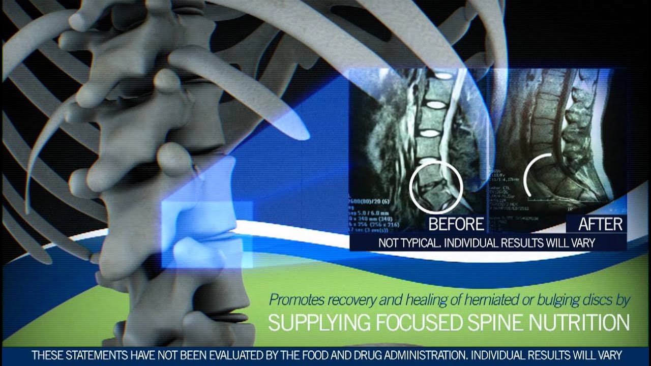 The World's First Spinal Disc Revitalizer - ReVITALize Your Recovery ...