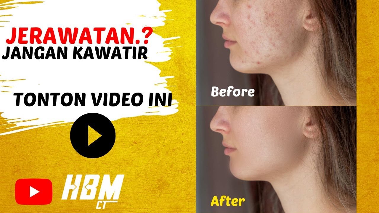 JERAWATAN.? JERAWAT HILANG DALAM 2 MENIT - ADOBE PHOTOSHOP TUTORIALS ...