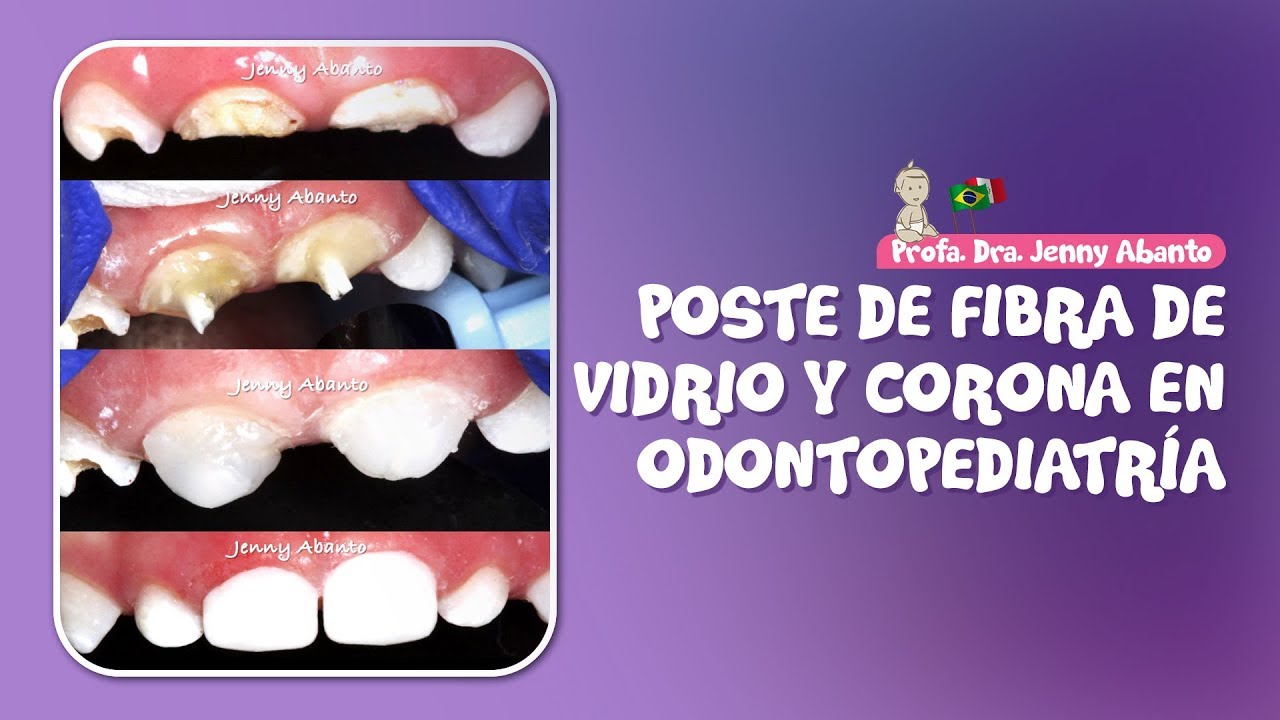POSTE DE FIBRA DE VIDRIO Y CORONA EN ODONTOPEDIATRÍA - YouTube