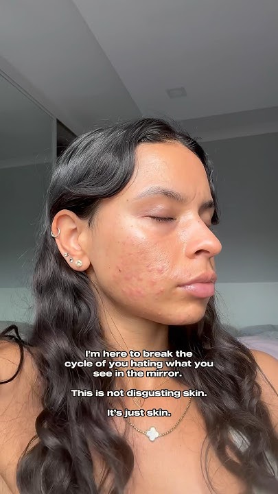 Your skin isn’t disgusting. Why do you believe it is? Do you really feel that way? - YouTube