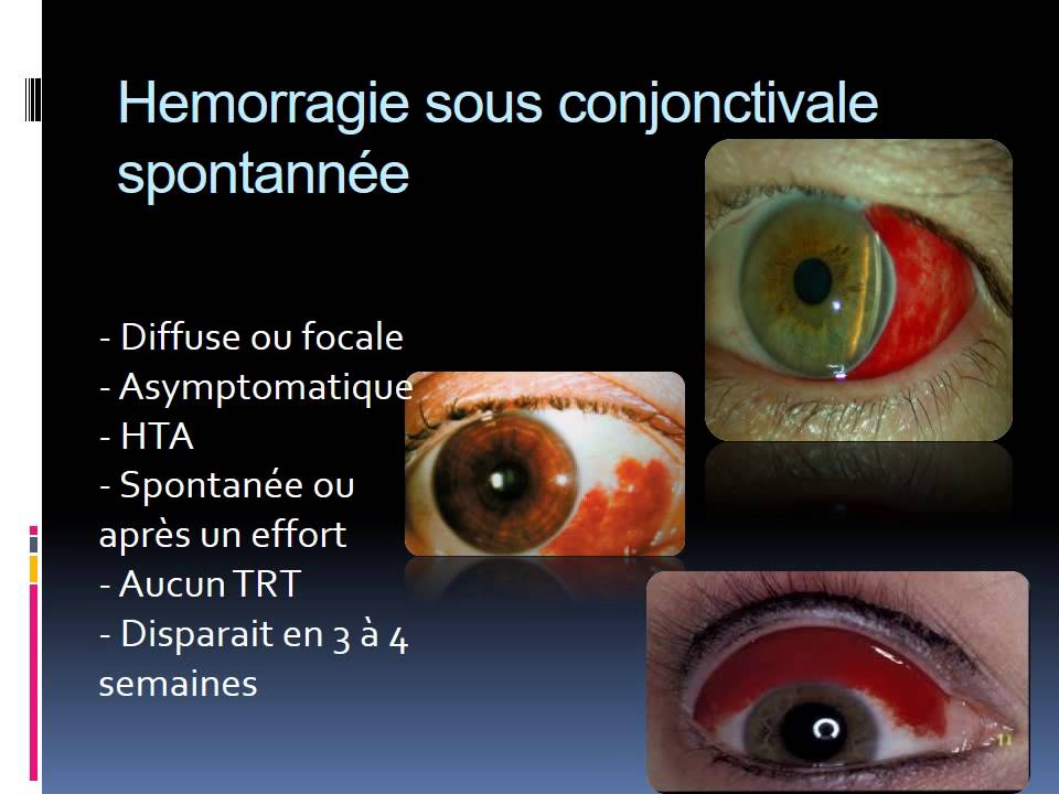 OPHTALMOLOGIE ŒIL ROUGE NON DOULEUREUX - YouTube