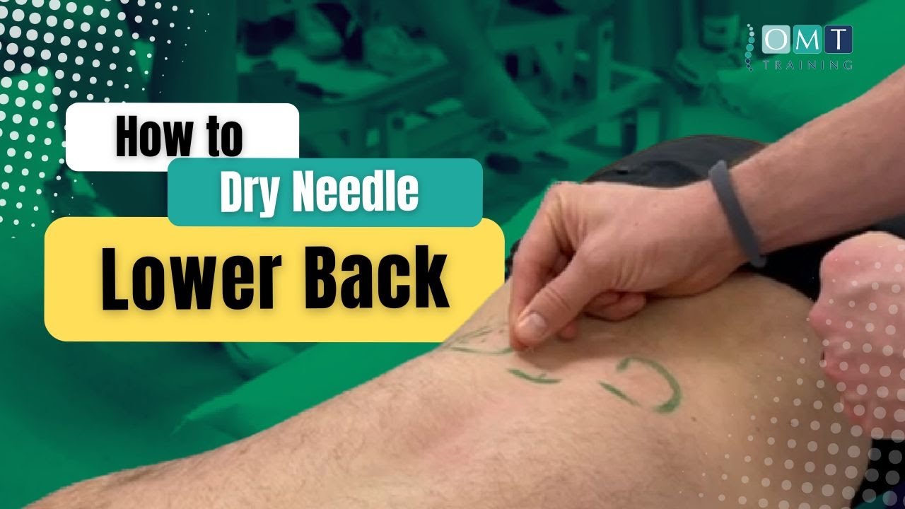 Dry Needling the Lower Back #medicalacupuncture #manualtherapy - YouTube