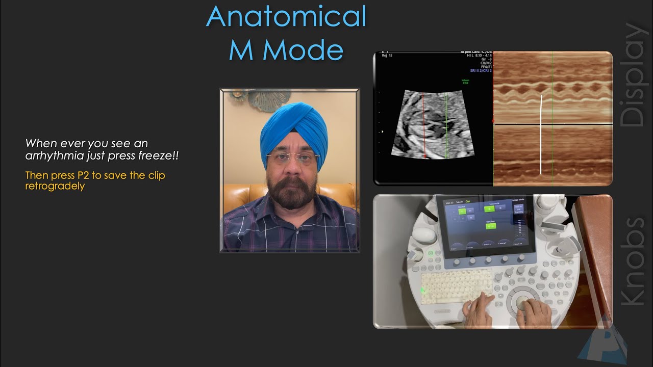 The Basics of M Mode Ultrasound for Fetal Heart Assessment | Part 2 ...
