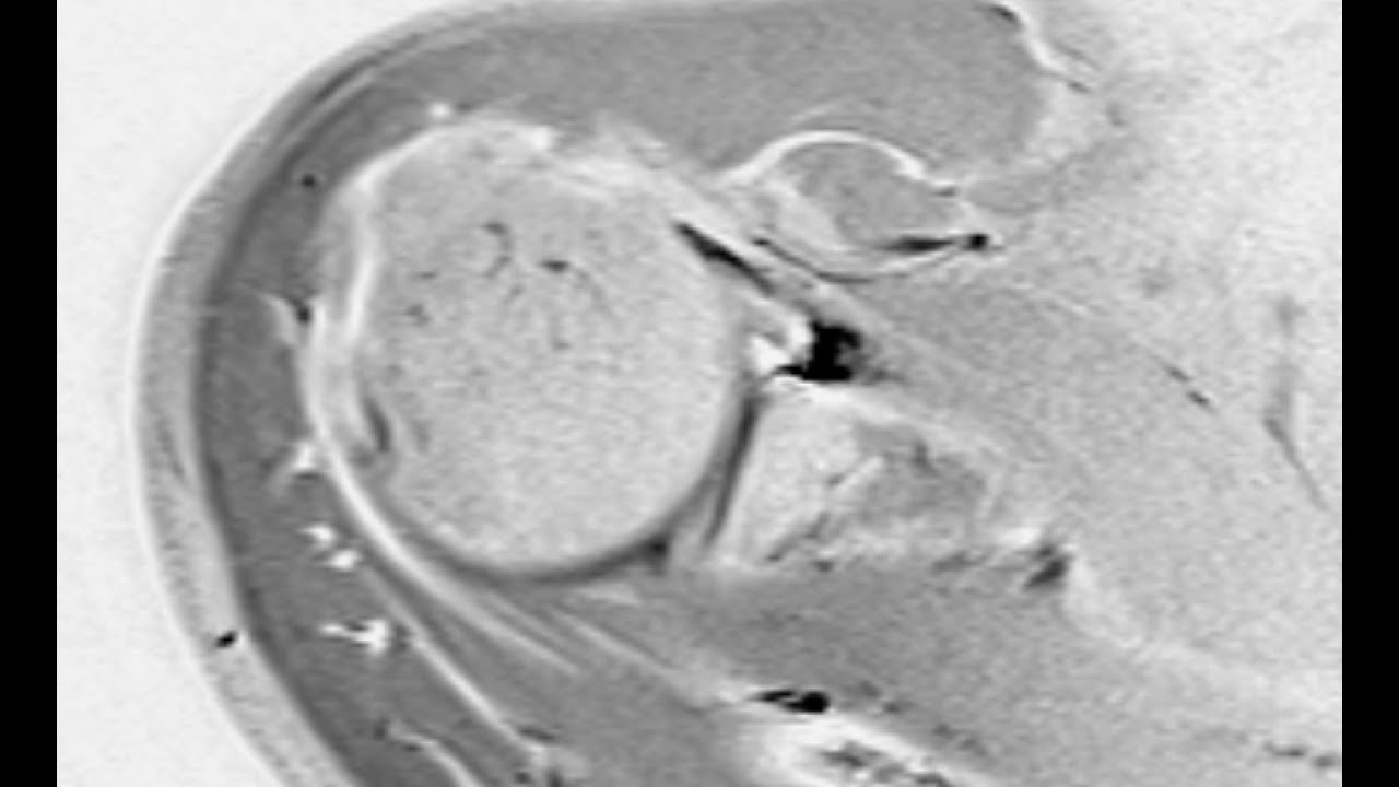 Anterior Inferior Labrum Tear of the Shoulder - YouTube
