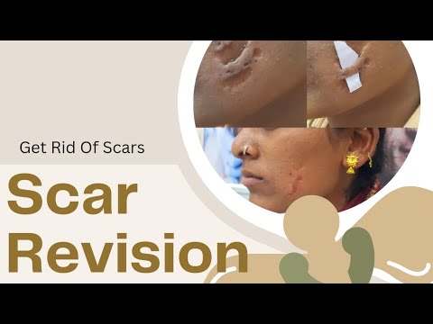 What Is Scar Revision Surgery ? How to Get Rid of Scar? Dr Amaresh ...
