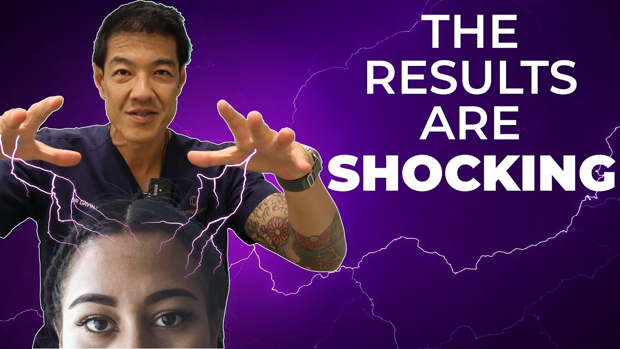 How to Zap your Face into Place | Facelift devices - YouTube