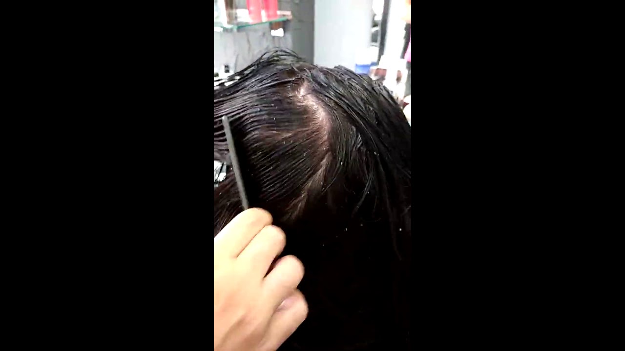 Scalp Peeling To Get Rid Of All The Dandruff Youtube