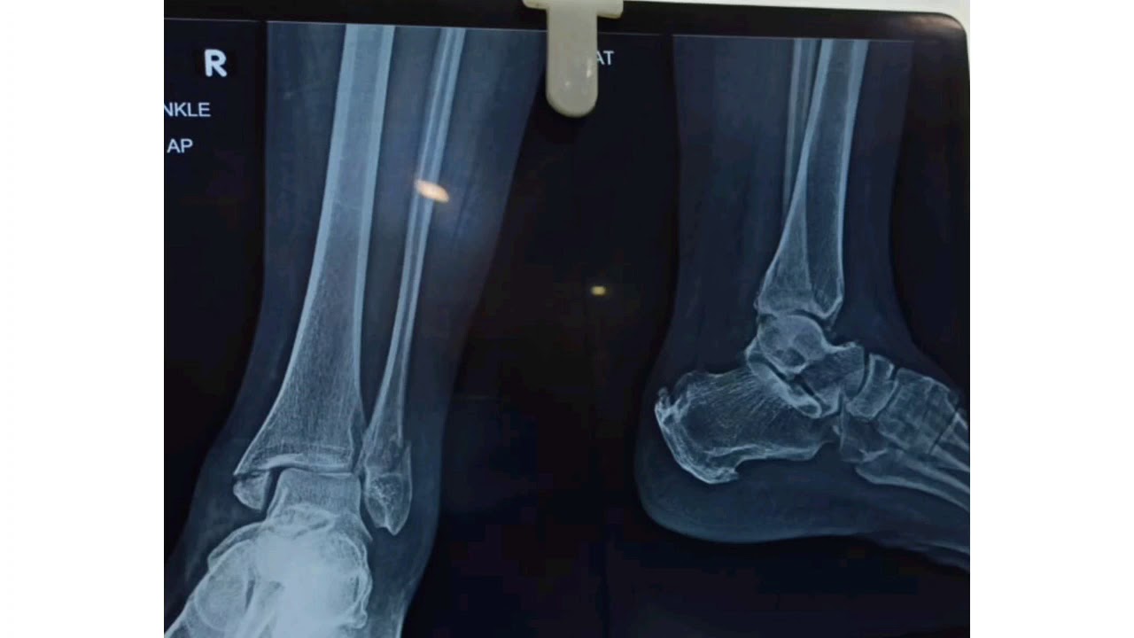 Bimalleolar ankle fracture fixation - YouTube