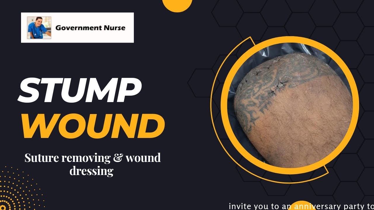 Remove sutures and stump wound dressing - YouTube