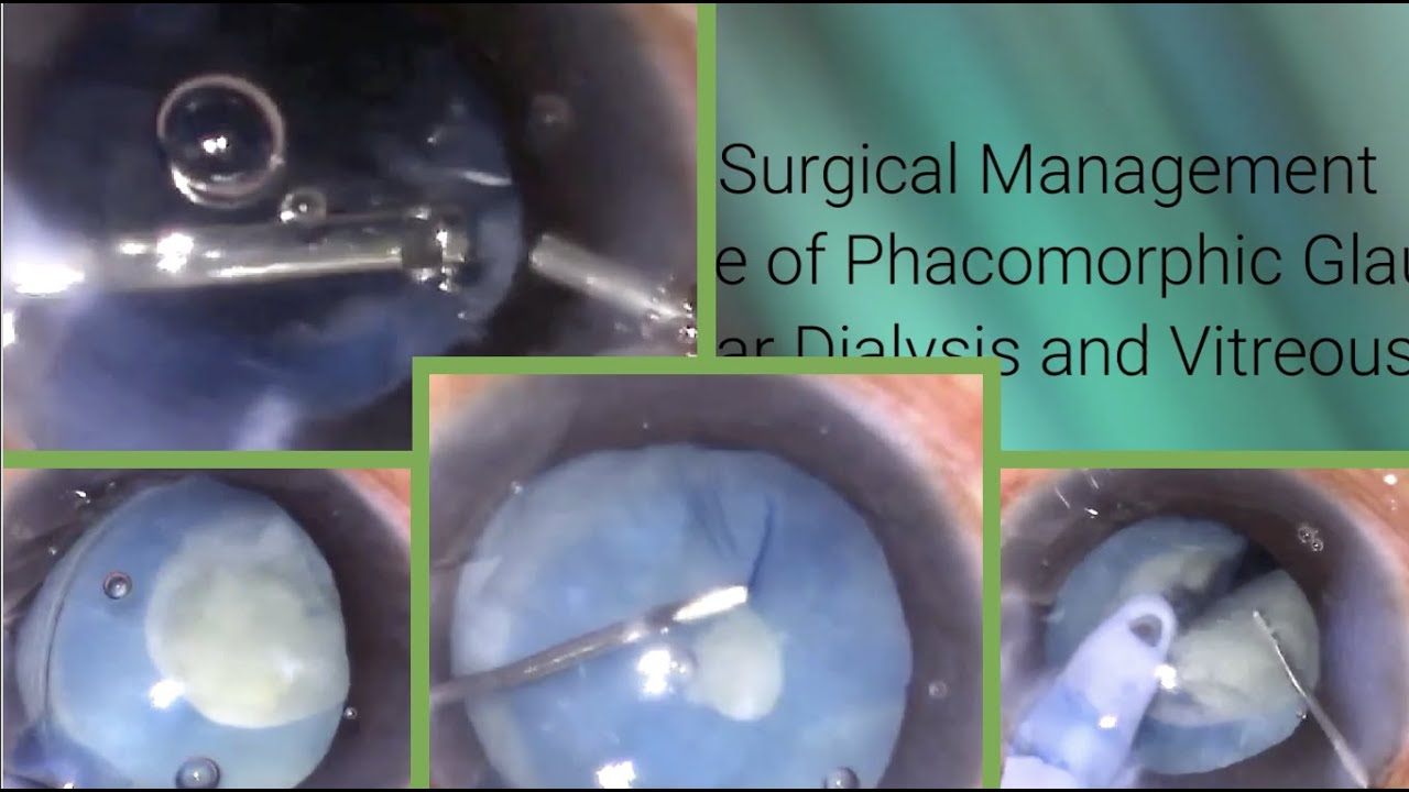 Surgical management of a case of phacomorphic glaucoma with zonular ...