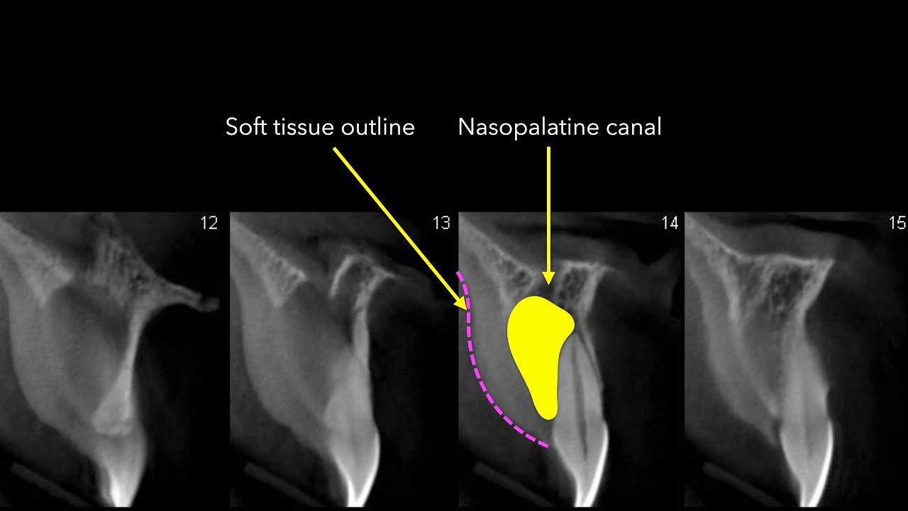 Nasopalatine Canal Radiograph Incidence Of Nasopalatine Canal