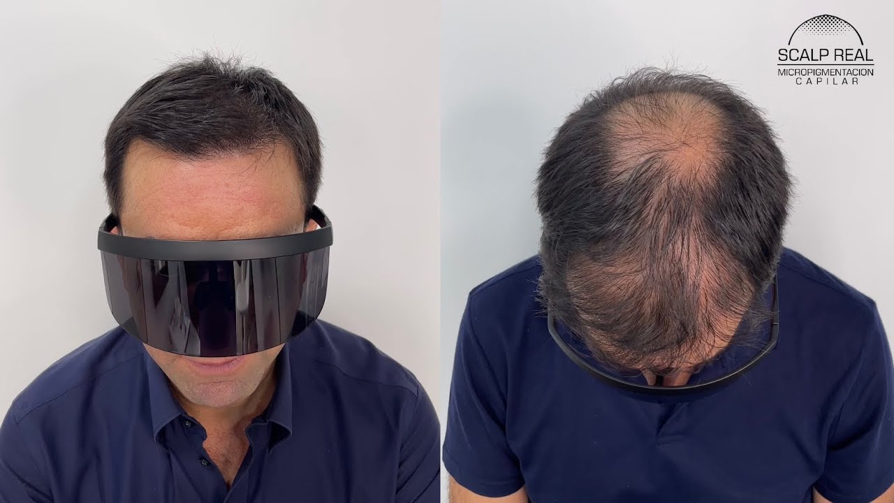 Micropigmentación capilar antes y después entradas y coronilla - YouTube