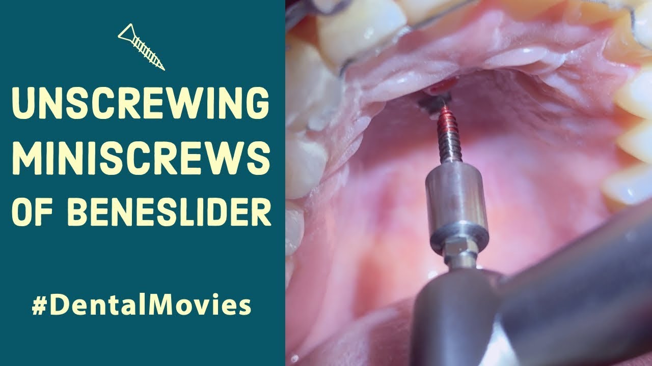 Unscrewing miniscrews of Beneslider - YouTube