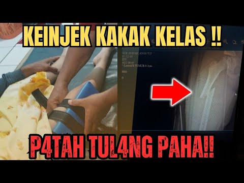 TERLIHAT JELAS‼️PAT4H TUL4NG PAHA AKIBAT KEINJ4K KAKAK KELAS SAAT BERMAIN DI SEKOLAH‼️KASIAN 😭