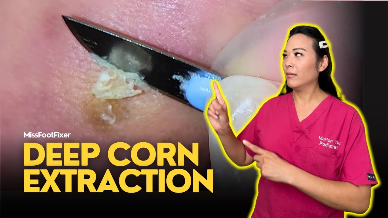 Deep Seated Corn Removal - Painful Yet Satisfying | FootClinicLondon.co ...
