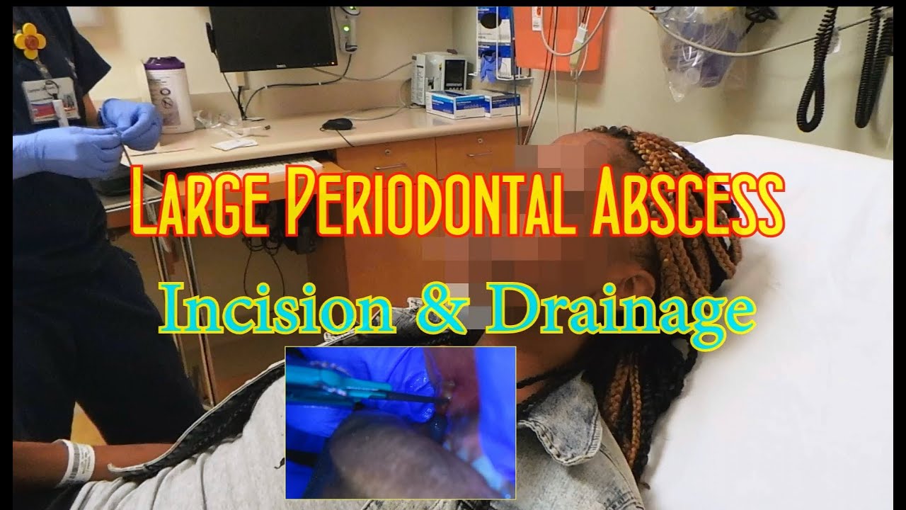 Periodontal Abscess Incision - YouTube