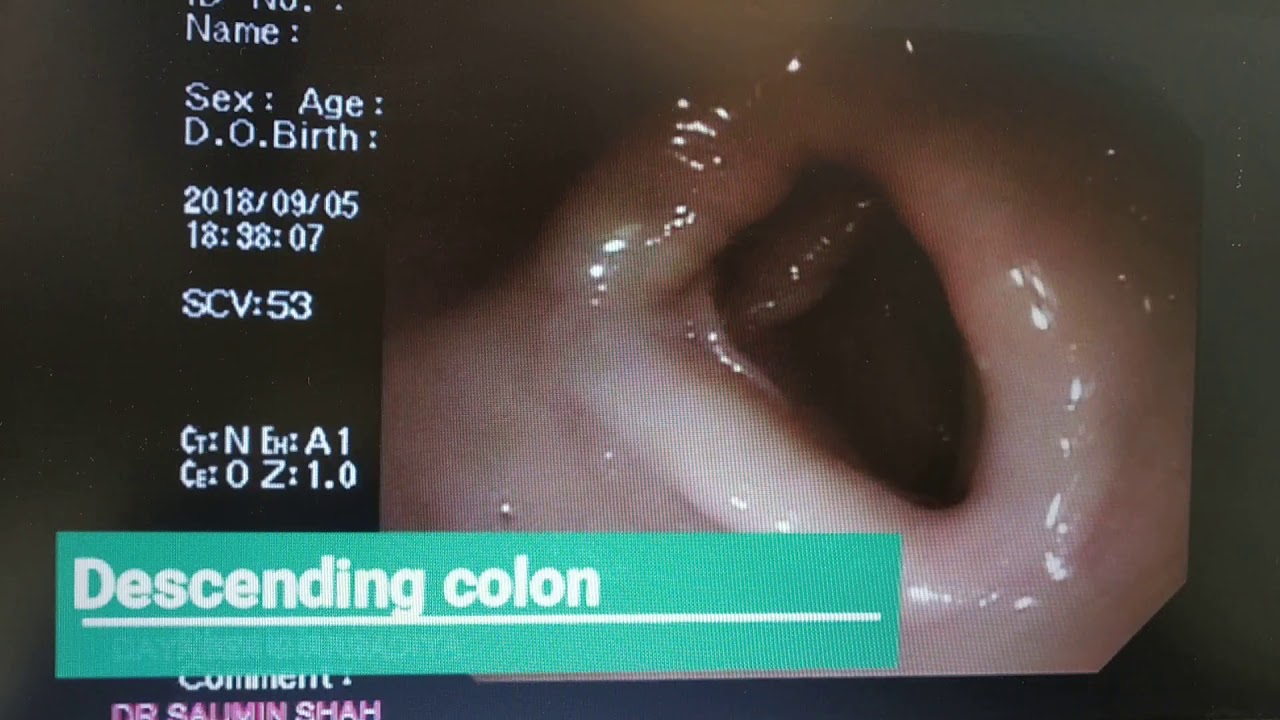 Colonoscopy - YouTube