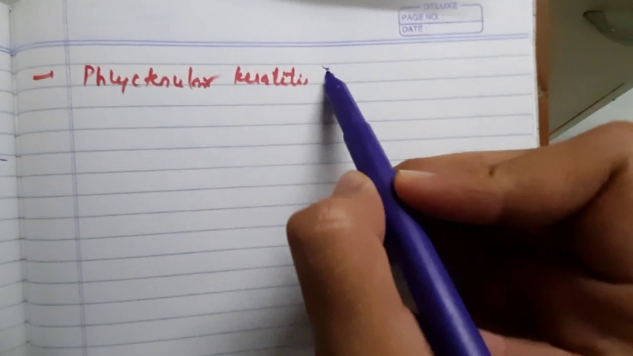 Phlyctenular Keratoconjunctivitis...ophthalmology - YouTube