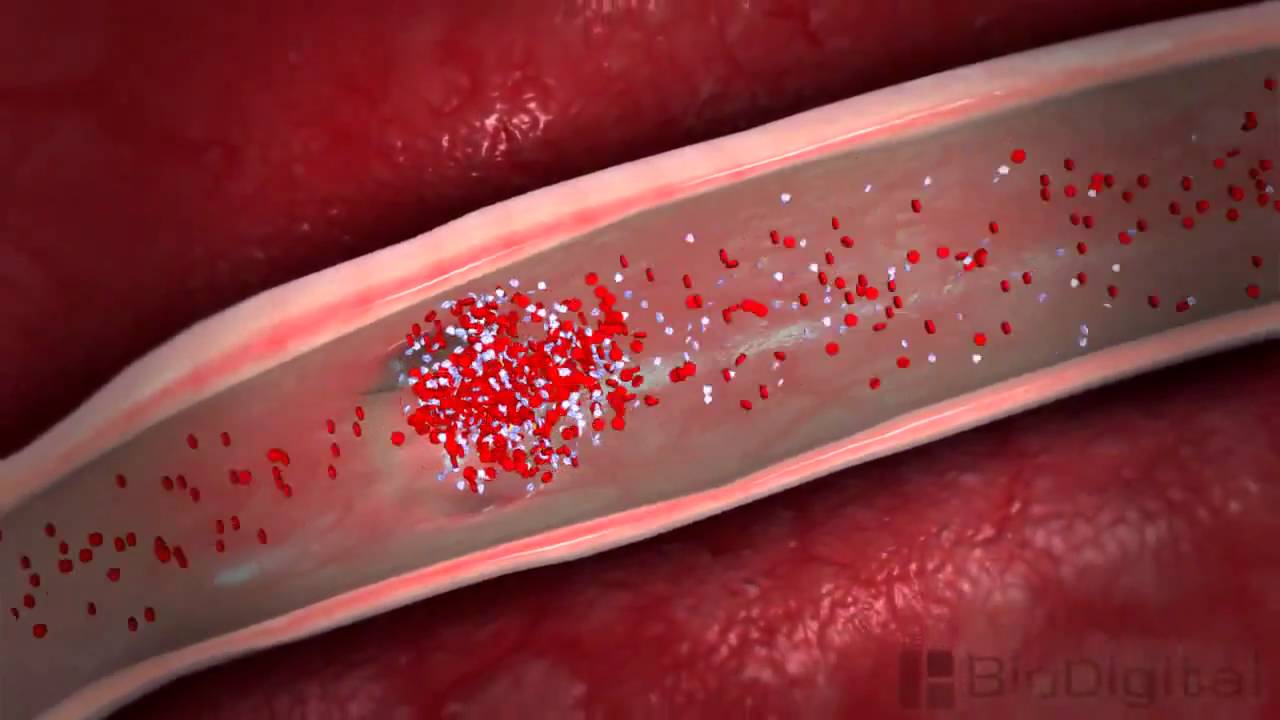 3D Medical Animation What is a Heart Attack - YouTube