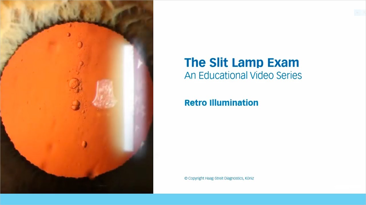 The Slit Lamp Exam – Episode 5, Retro Illumination - YouTube