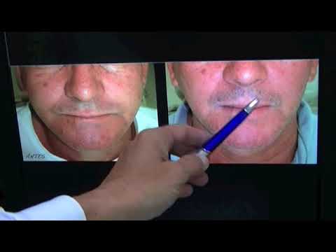 Dentadura: boca murcha e face envelhecida - YouTube