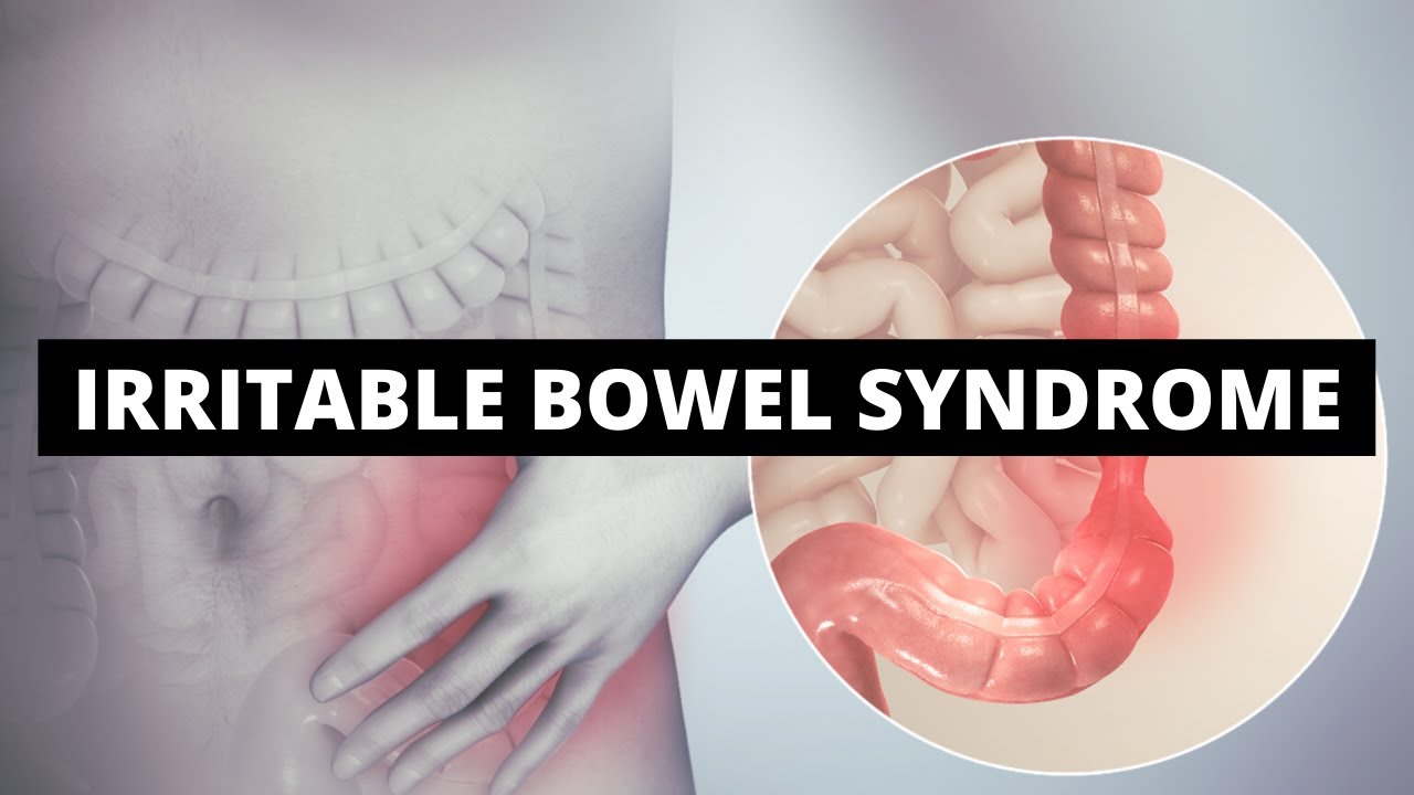 Irritable Bowel Syndrome | High Yield Topic | USMLE | MCI/FMGE/NEXT ...
