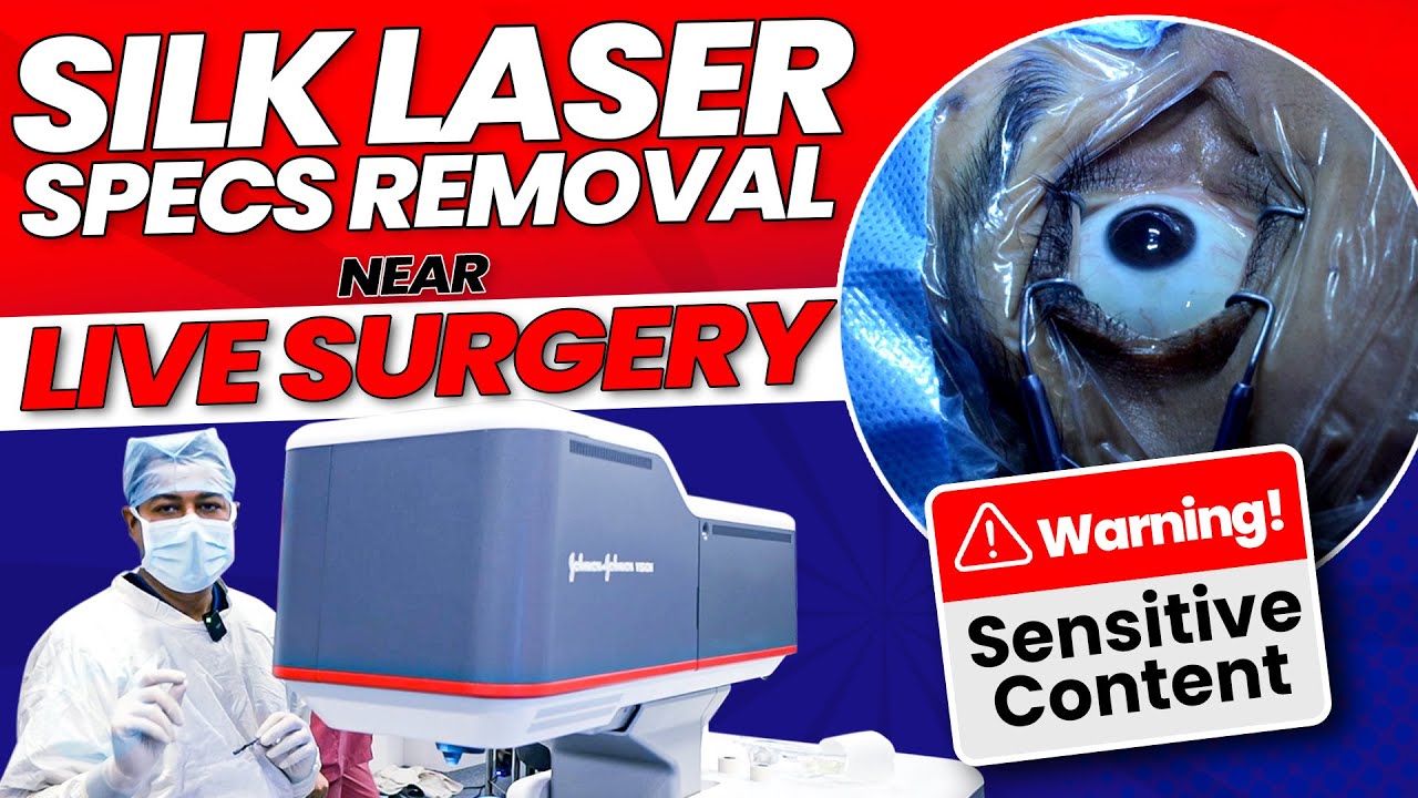 SiLK Laser Specs Removal - Near LIVE Surgery by Dr. Rahil Chaudhary ...