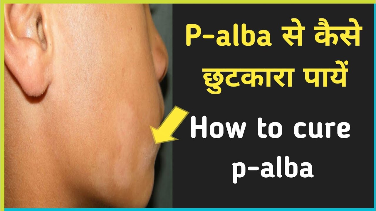 how to cure p-alba? - YouTube